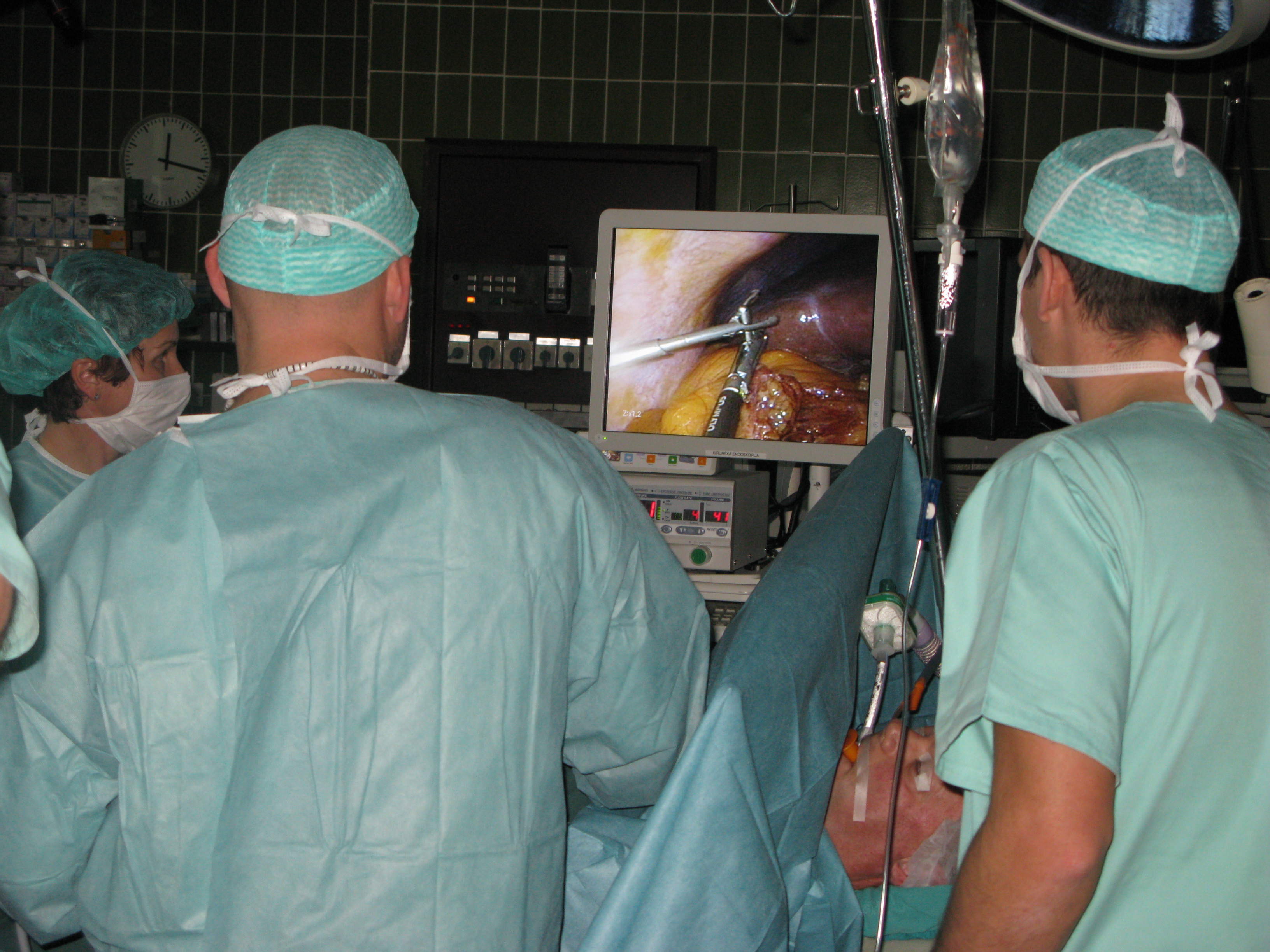 Operacija žolčnika le skozi odprtino na popku pacienta